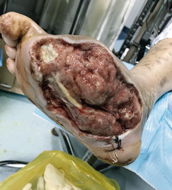 A Case of Diabetic Foot Complicated with Osteomyelitis and Refractory ...