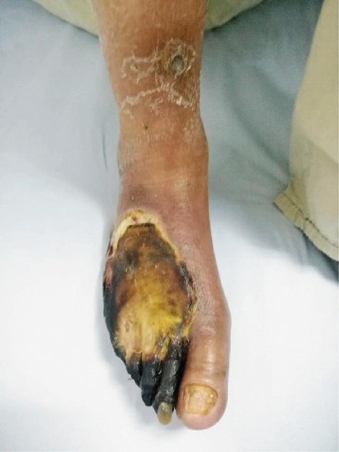 A Case of Limb Preservation in Type 2 Diabetic Foot Gangrene | SpringerLink