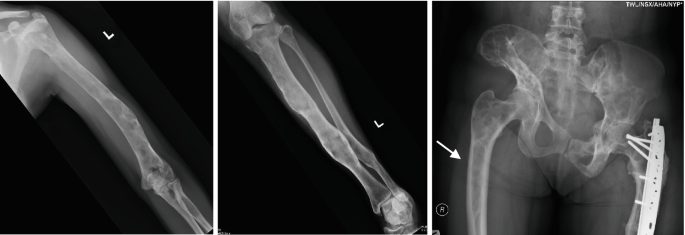 Fibrous Dysplasia | SpringerLink