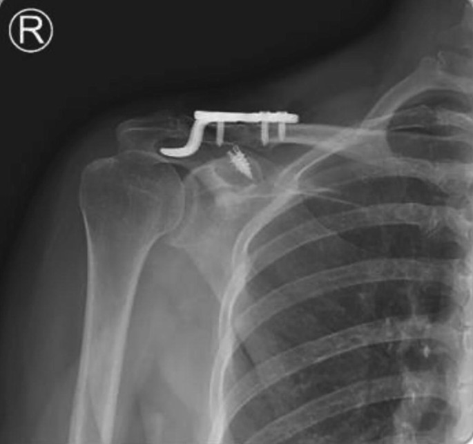 Complications and Countermeasures of Hook Steel Plate Fixation Surgery ...