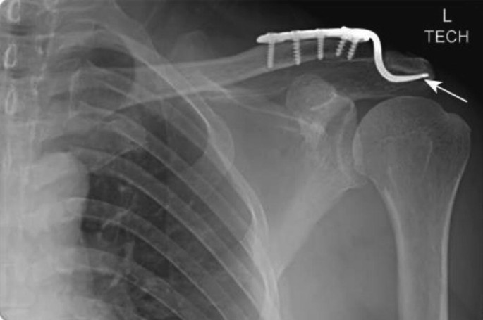 Complications and Countermeasures of Hook Steel Plate Fixation Surgery ...