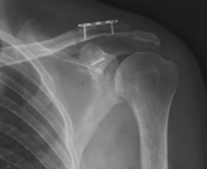 Complications and Countermeasures of Hook Steel Plate Fixation Surgery ...