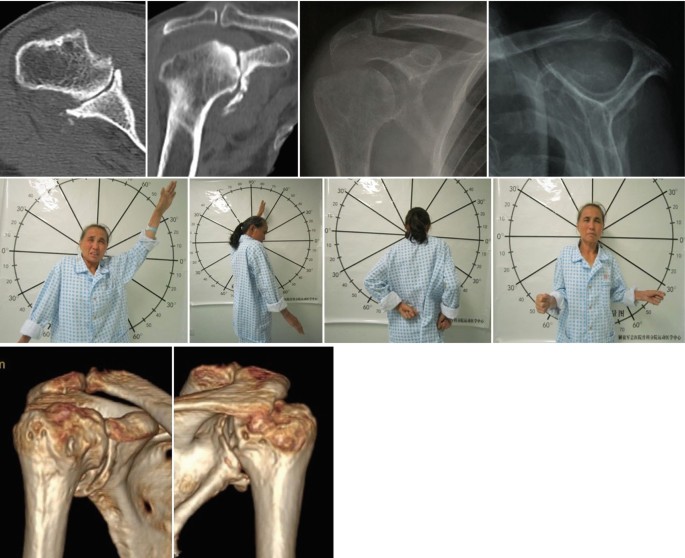 Diagnostic and Therapeutic Misconceptions in Syphilitic Arthritis of ...