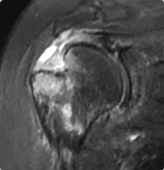 Errors in Diagnosis and Treatment of Humerus Macrotuberous Fracture and ...