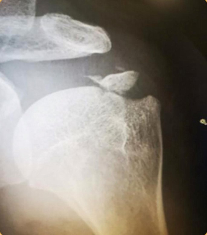 Surgical Errors and Strategies of Humerus Greater Tubercle Fracture ...