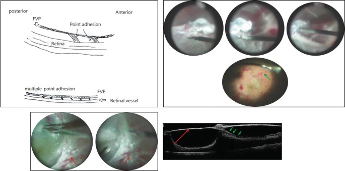 Fibrovascular Proliferation and Tractional Retinal Detachment ...