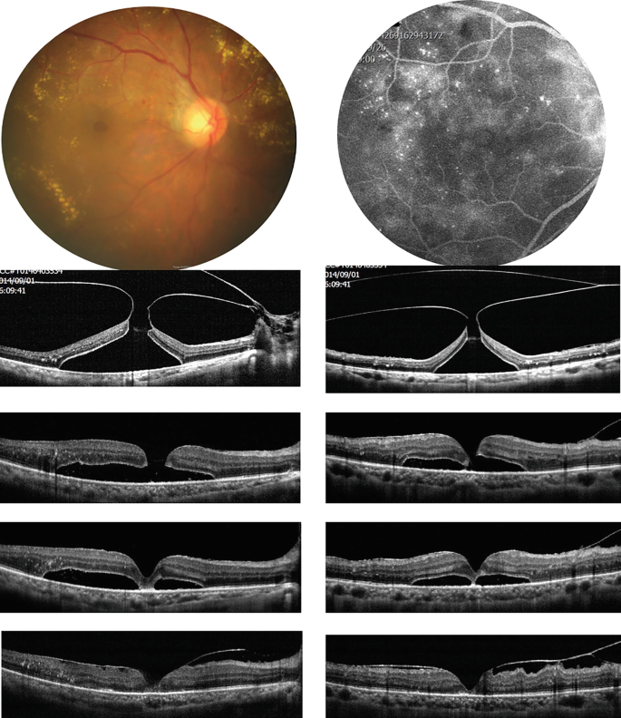 Vitreomacular Traction in Diabetic Retinopathy | SpringerLink