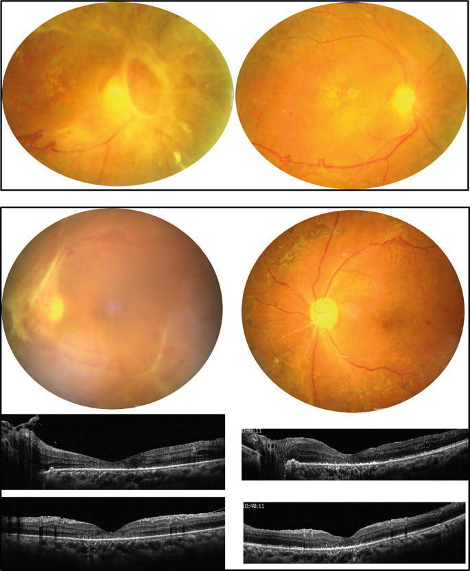 Vitreopapillary Traction in Proliferative Diabetic Retinopathy ...