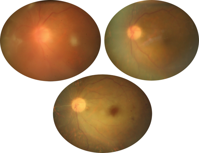Retinal Vessel Occlusion After Diabetic Vitrectomy | SpringerLink