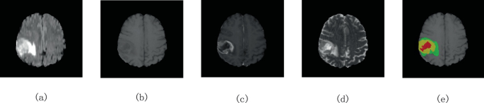 MBDR-V2: A Network for MRI Brain Tumor Image Segmentation with ...