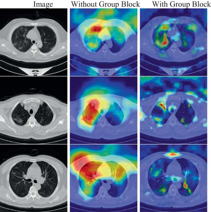 A Novel Group Block Attention Module for Lung CT Image Segmentation ...