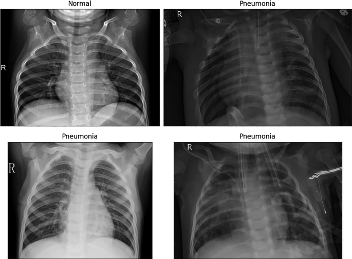 Detection and Classification of Pneumonia from Chest X-rays Using Image ...