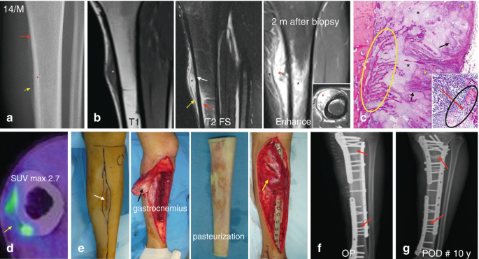Periosteal Osteosarcoma | Springer Nature Link