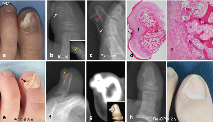 Subungual Exostosis | SpringerLink