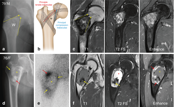 Liposclerosing Myxofibrous Tumor (LSMFT) | SpringerLink