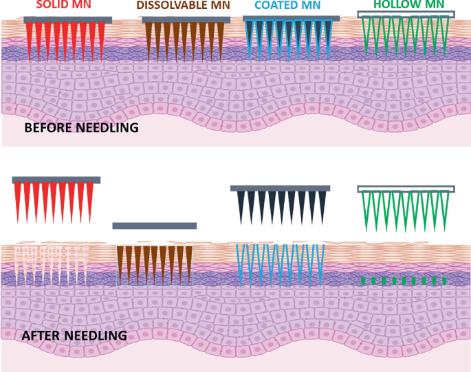 Microneedles as Carriers: A Futuristics Delivery System for Medicines ...