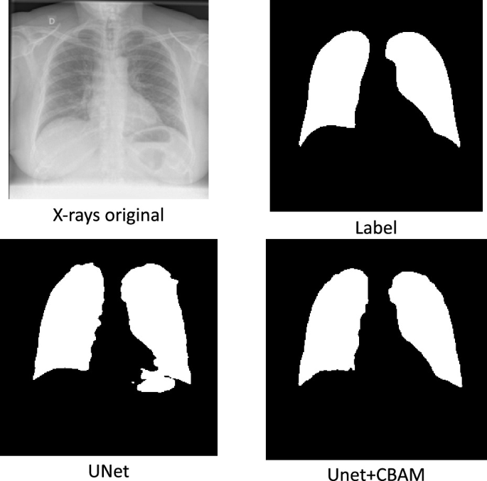 Lung CT Image Segmentation Algorithm Based on Improved UNet | SpringerLink