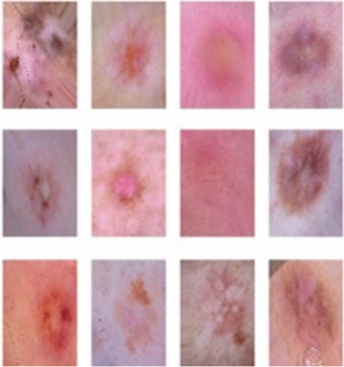 Exploring Skin Lesion Classification Through Explainable AI—Leveraging ...