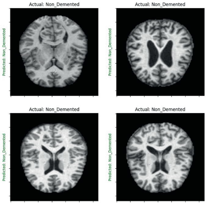 Alzheimer’s Disease Prediction and Classification Using Deep Learning ...