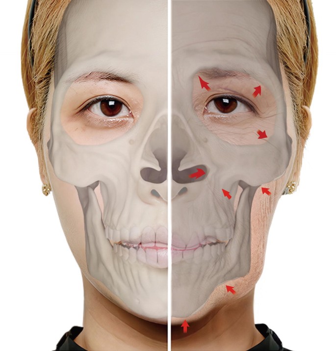 Changes in the Face Related to Aging Process | SpringerLink
