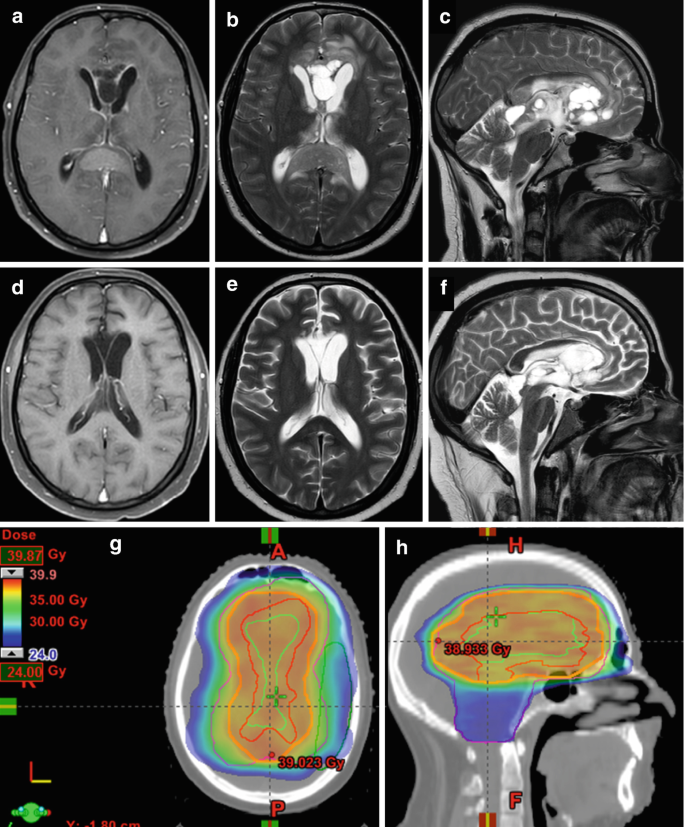 Intracranial Germ Cell Tumors | SpringerLink