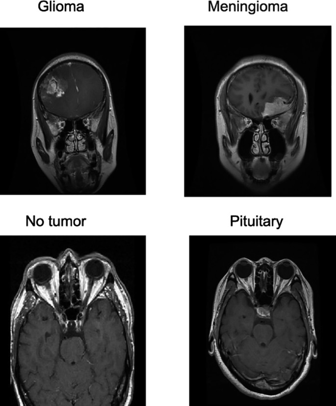 Attention-Augmented MobileNetV2 for MRI-Based Brain Tumor ...