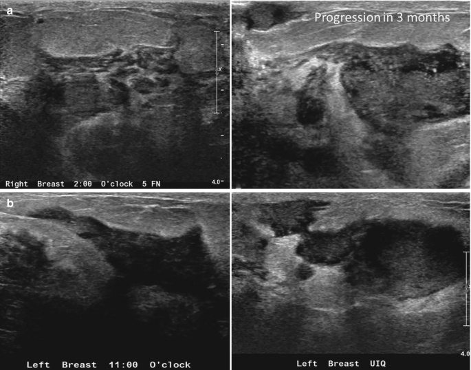 Mastitis | SpringerLink