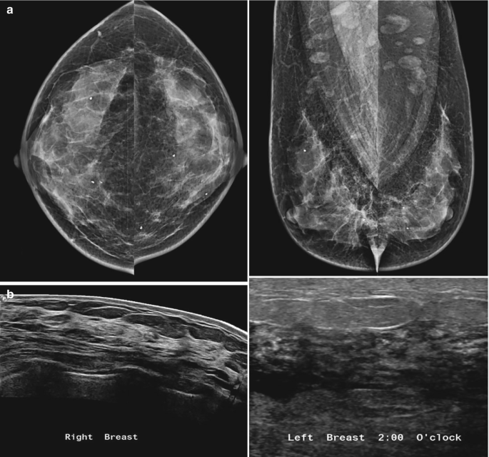 Mastitis | SpringerLink
