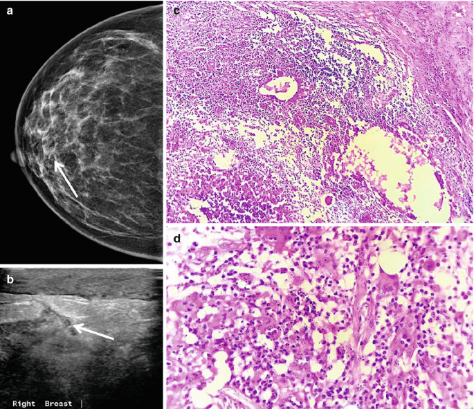 Mastitis | SpringerLink