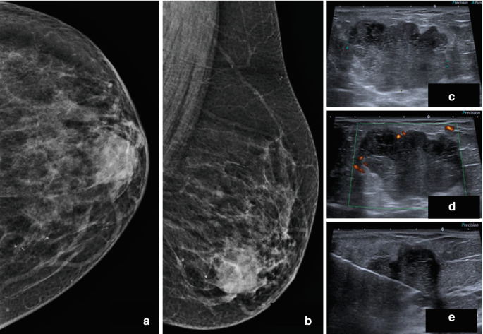 Unusual Breast Cancers | SpringerLink