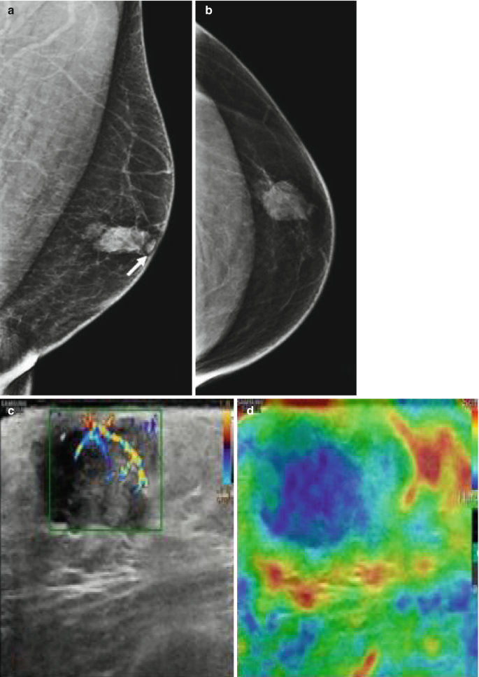 Imaging and Approach in Male Breast Diseases | SpringerLink