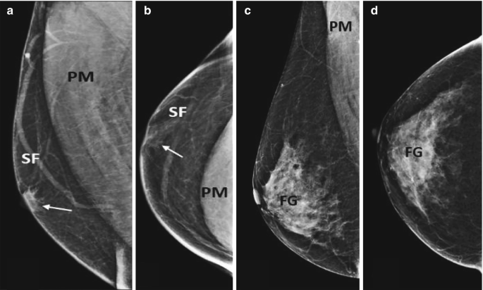Imaging and Approach in Male Breast Diseases | SpringerLink