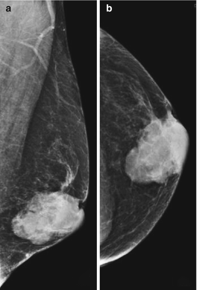 Imaging and Approach in Male Breast Diseases | SpringerLink