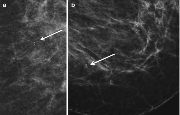 Approach to Calcifications | SpringerLink