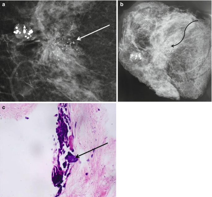 Approach to Calcifications | SpringerLink