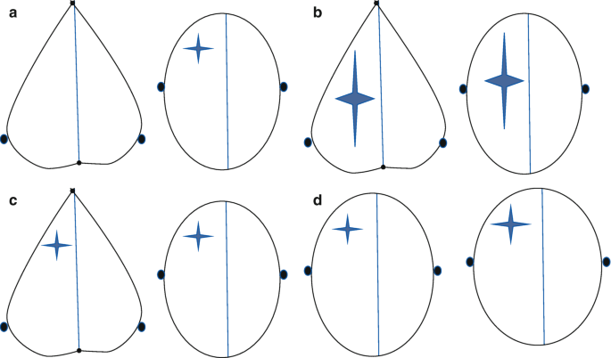 Asymmetries and Architectural Distortion | SpringerLink