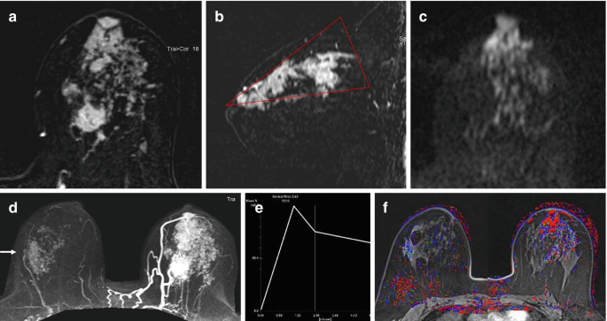 Approach to Non-mass Enhancement on MRI | SpringerLink