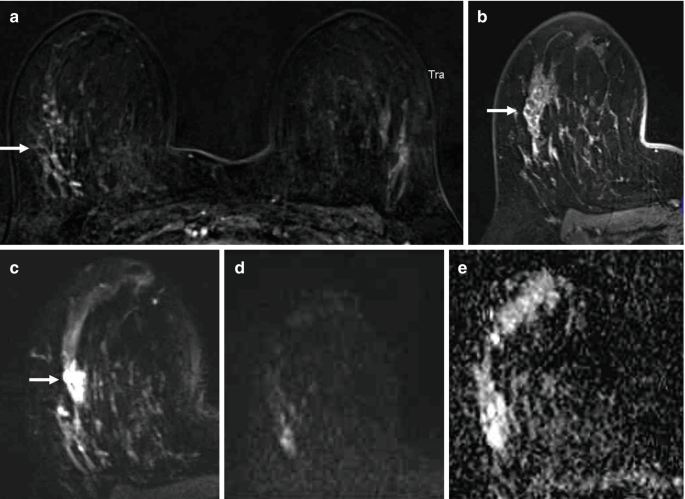 Approach to Non-mass Enhancement on MRI | Springer Nature Link