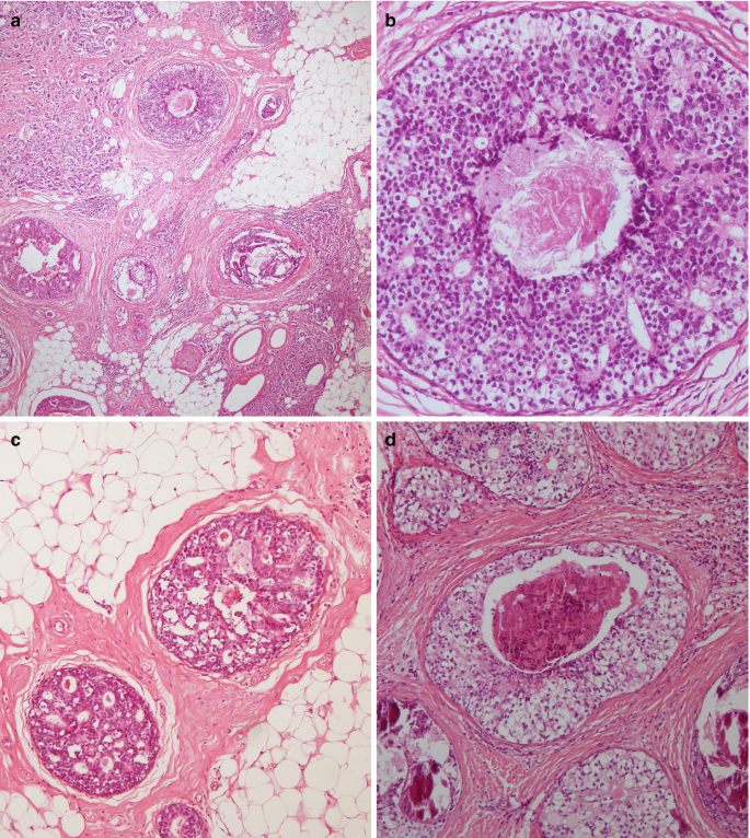 Ductal Carcinoma In Situ: Imaging and Management | SpringerLink