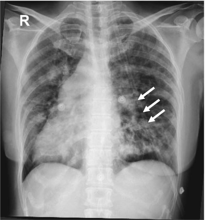 Kartagener Syndrome: A Rare Autosomal Recessive Disorder | SpringerLink