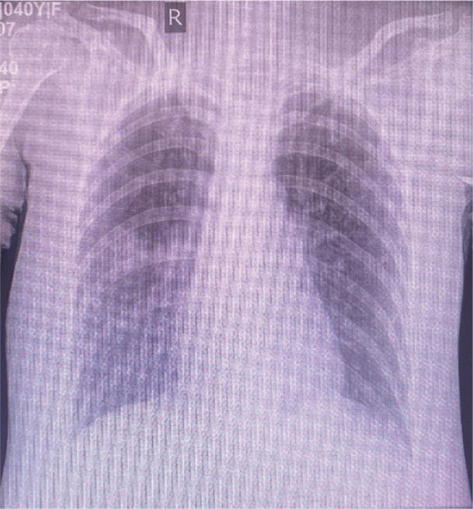 Bronchoscopy in Burn Inhalation Injury | Springer Nature Link (formerly ...