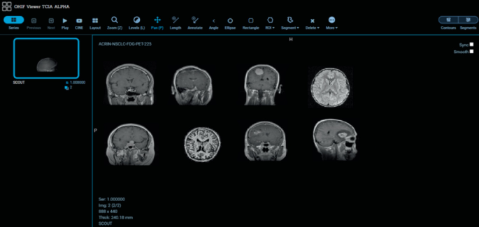 GliomaAI: Advanced Detection and Classification of Brain Tumor with ...