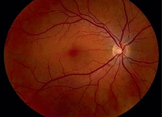 Retinal Vessel Image Segmentation Using U-Net and Channel Attention ...