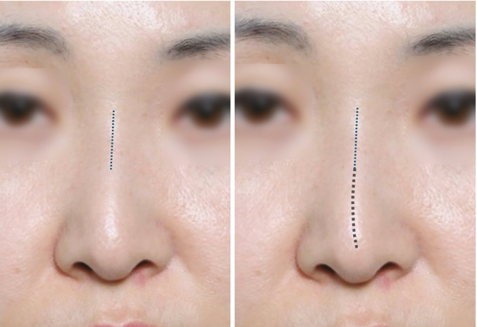 Septal L-Strut Extension Graft (SLEG) for Deviated Nose in Asians ...