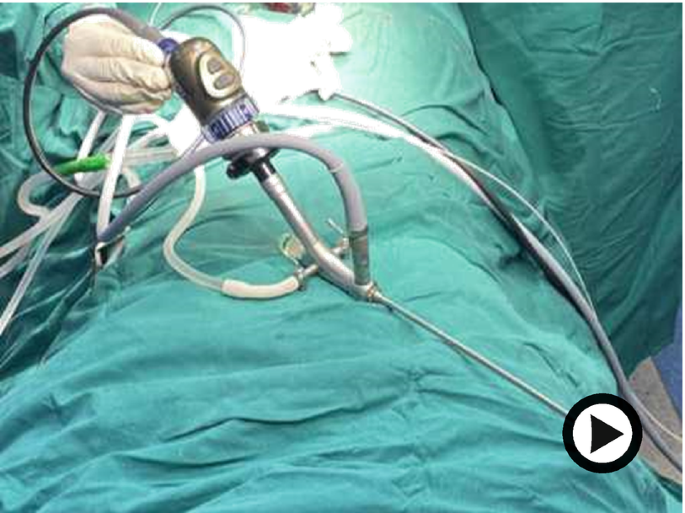 Fistula in Ano: Sphincter-Saving Procedures VAAFT/Video-Assisted Anal ...