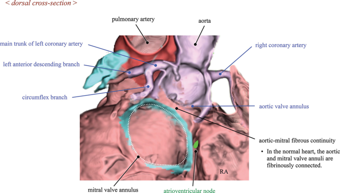 Congenital Aortic Stenosis (AS), Aortic Regurgitation (AR) | Springer ...