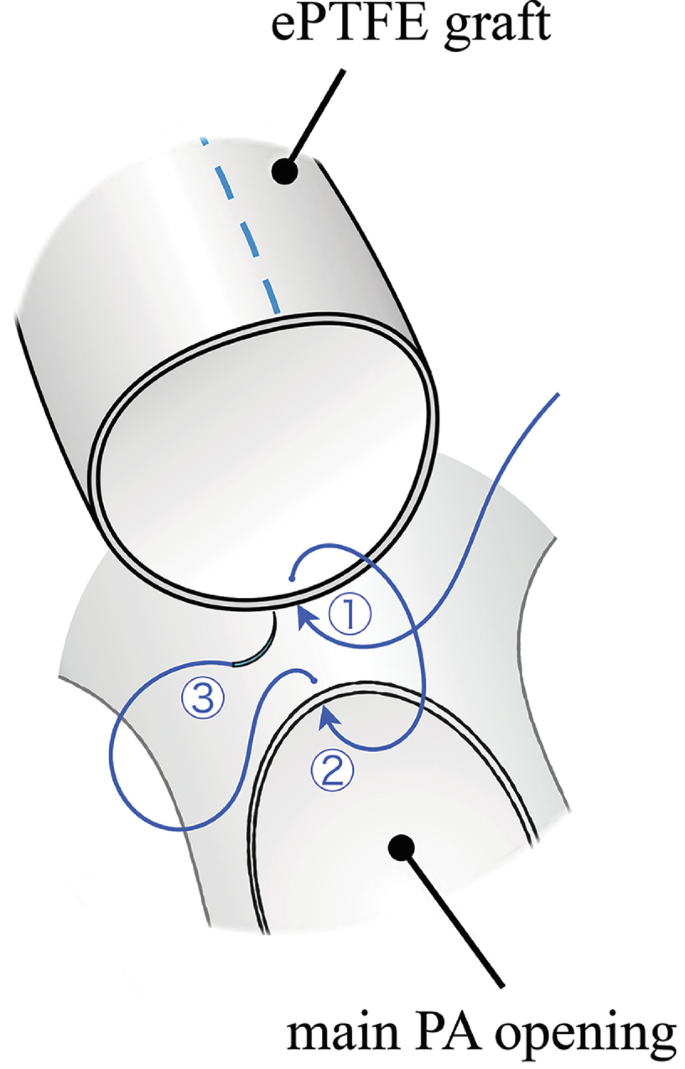 Pulmonary Stenosis (PS) | Springer Nature Link (formerly SpringerLink)