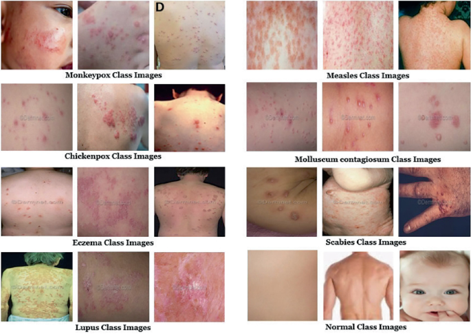 Efficient Monkeypox Diagnosis Via Attention-Based MobileNetV2 ...