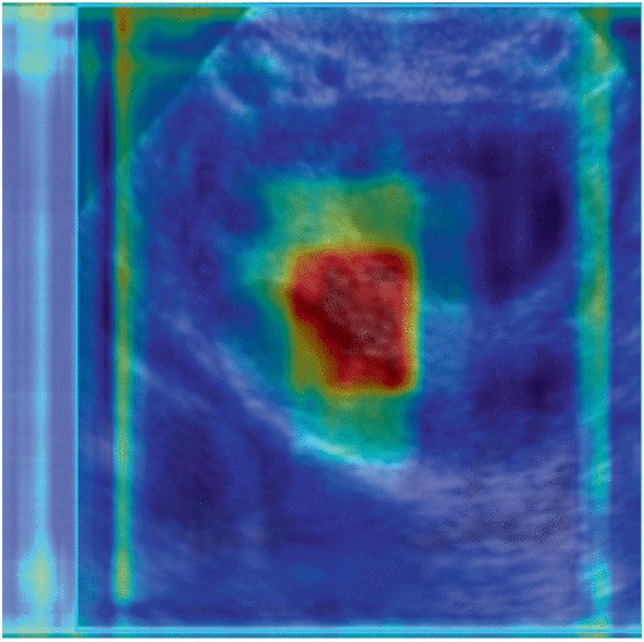 Explainable AI for PCOS Diagnosis: A YOLOv8 and Vision Transformer ...