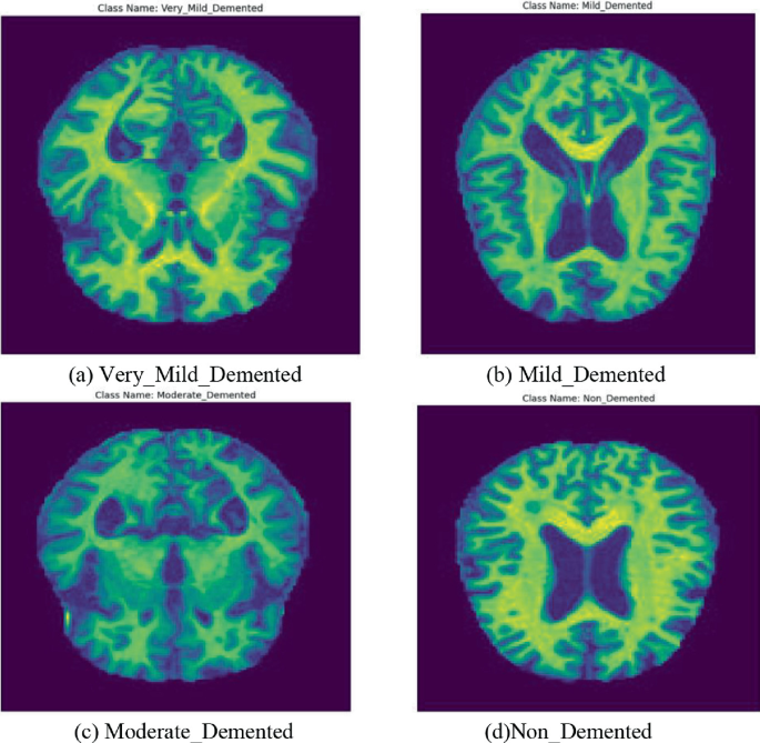 Performance Improvement of an Automated Alzheimer Classification System ...